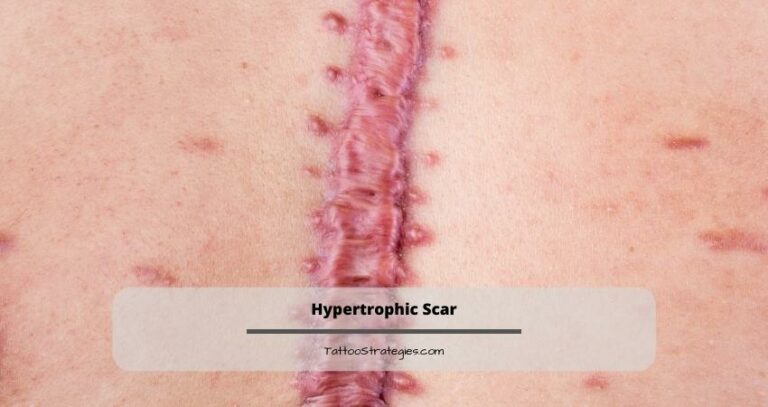 Can You Tattoo Over Burn Scars? Or Is There Any Risk? – Tattoo Strategies